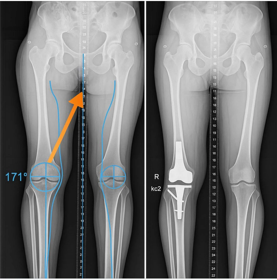 Side-by-side X-rays showing a person's legs before and after a total ...